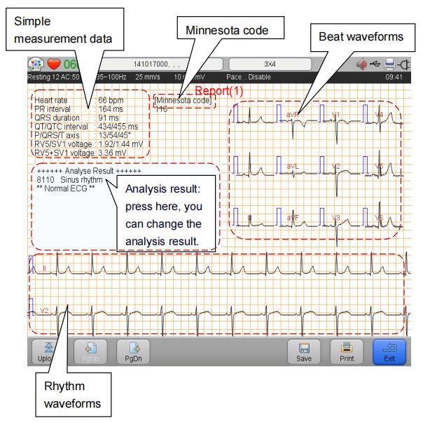 Touchscreen Interpretive 12-Lead EKG Machine for Rapid ECG Diagnosis with 6-Channel Support ...